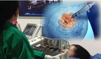 Prevención del cáncer de mama con la Biopsia Core